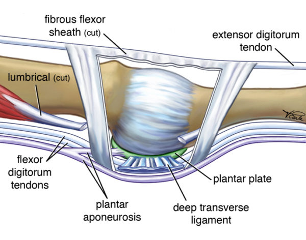 Plantar Plate Tears - Queensland Orthotic Lab