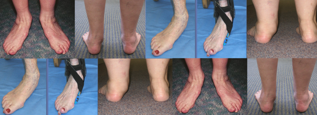 Clinical Pearls for the Flat Foot Patient – Part 2 - Queensland ...